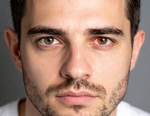 What Causes Red Eyes in Photos? — Barnet Dulaney Perkins Eye Center