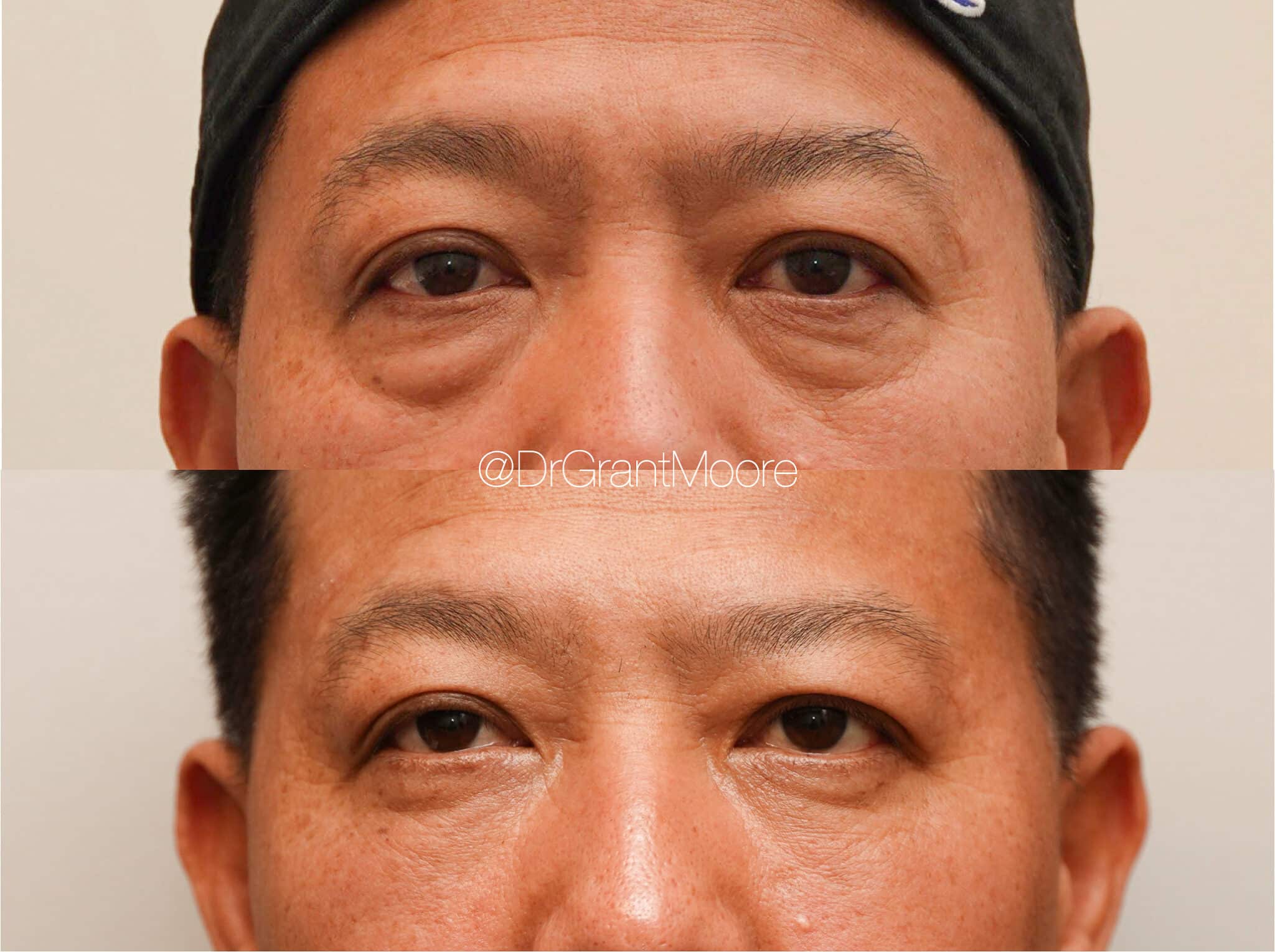 Ophthalmic Plastic Surgery Gallery | Barnet Dulaney Perkins AZ