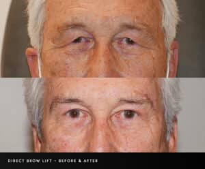 Brow Lift Surgery Scottsdale | Direct, Lateral, Endoscopic Brow Lift