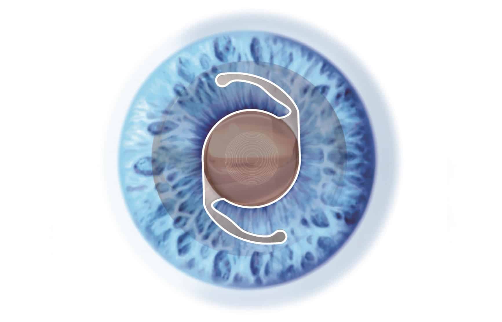 Iol Eye Lens