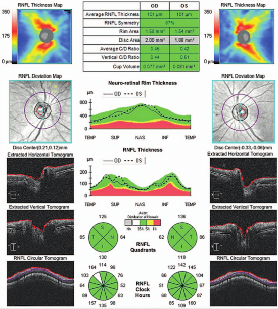 Understanding Glaucoma Test Results: What do They Mean?