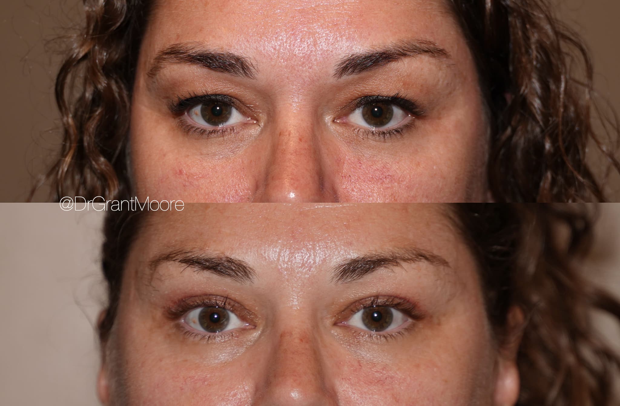 Upper Eyelid Blepharoplasty | Eyelid Lift — Barnet Dulaney Perkins Eye ...