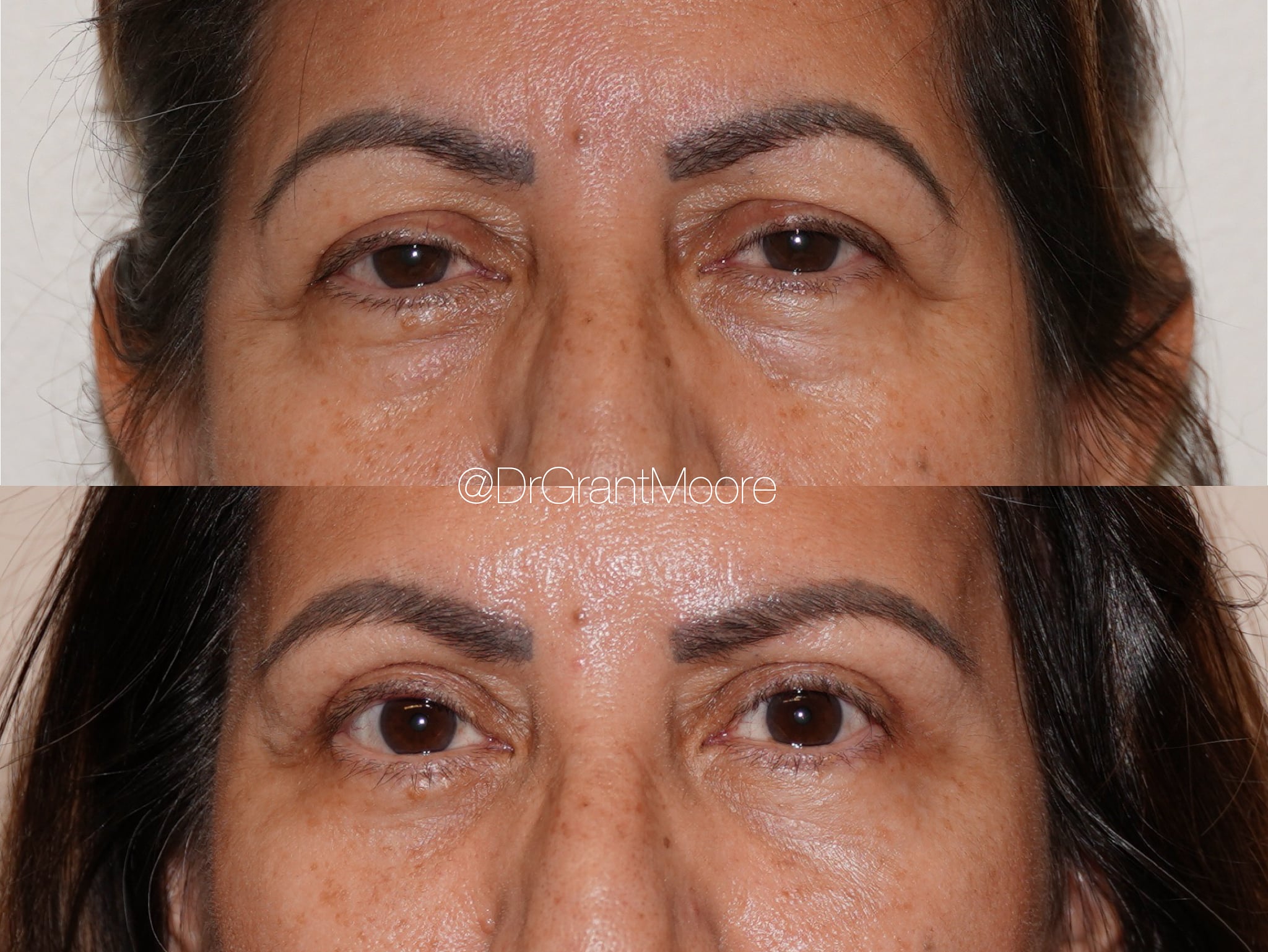 Upper Eyelid Blepharoplasty | Eyelid Lift — Barnet Dulaney Perkins Eye ...