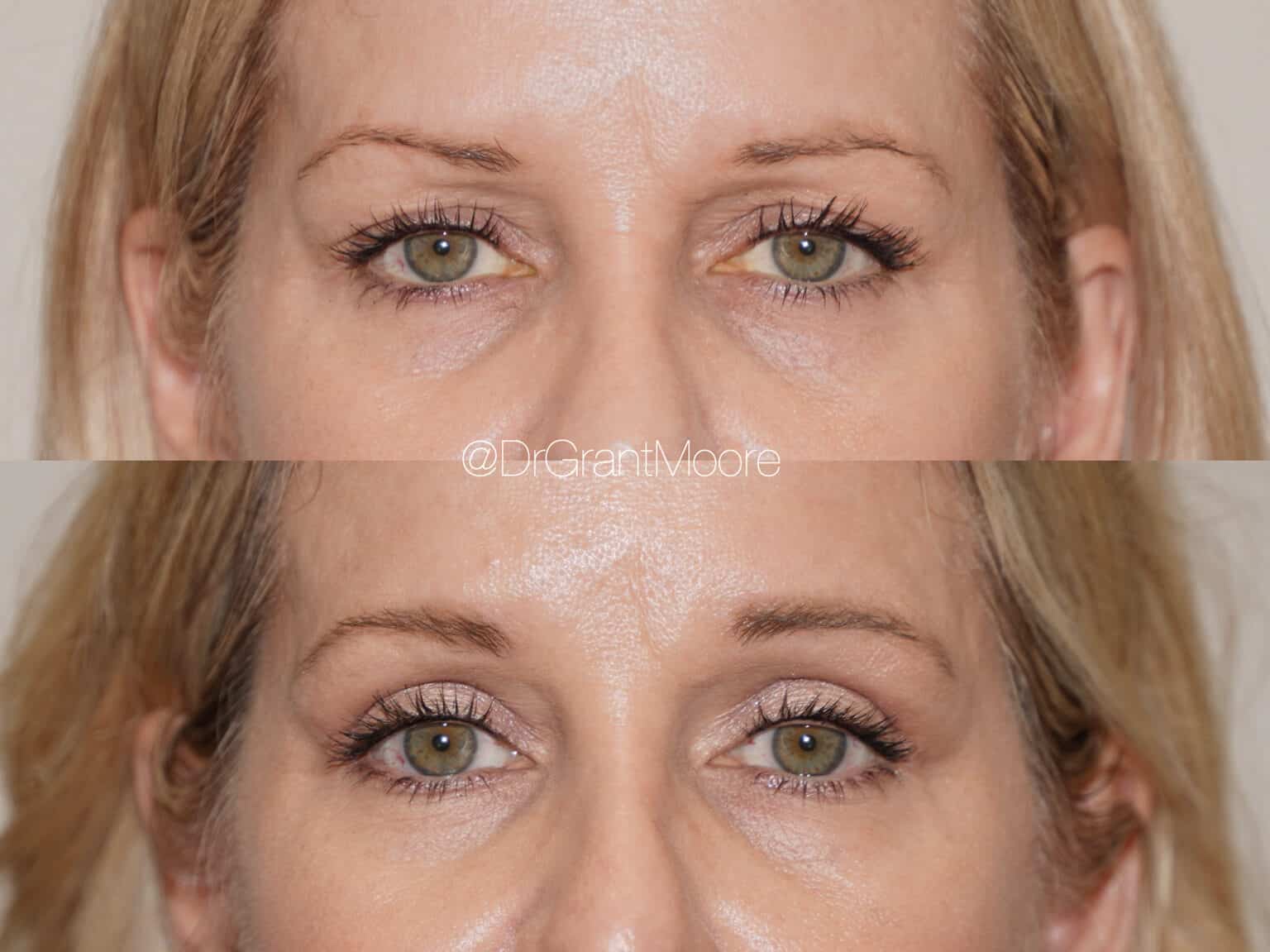 Upper Eyelid Blepharoplasty | Eyelid Lift — Barnet Dulaney Perkins Eye ...