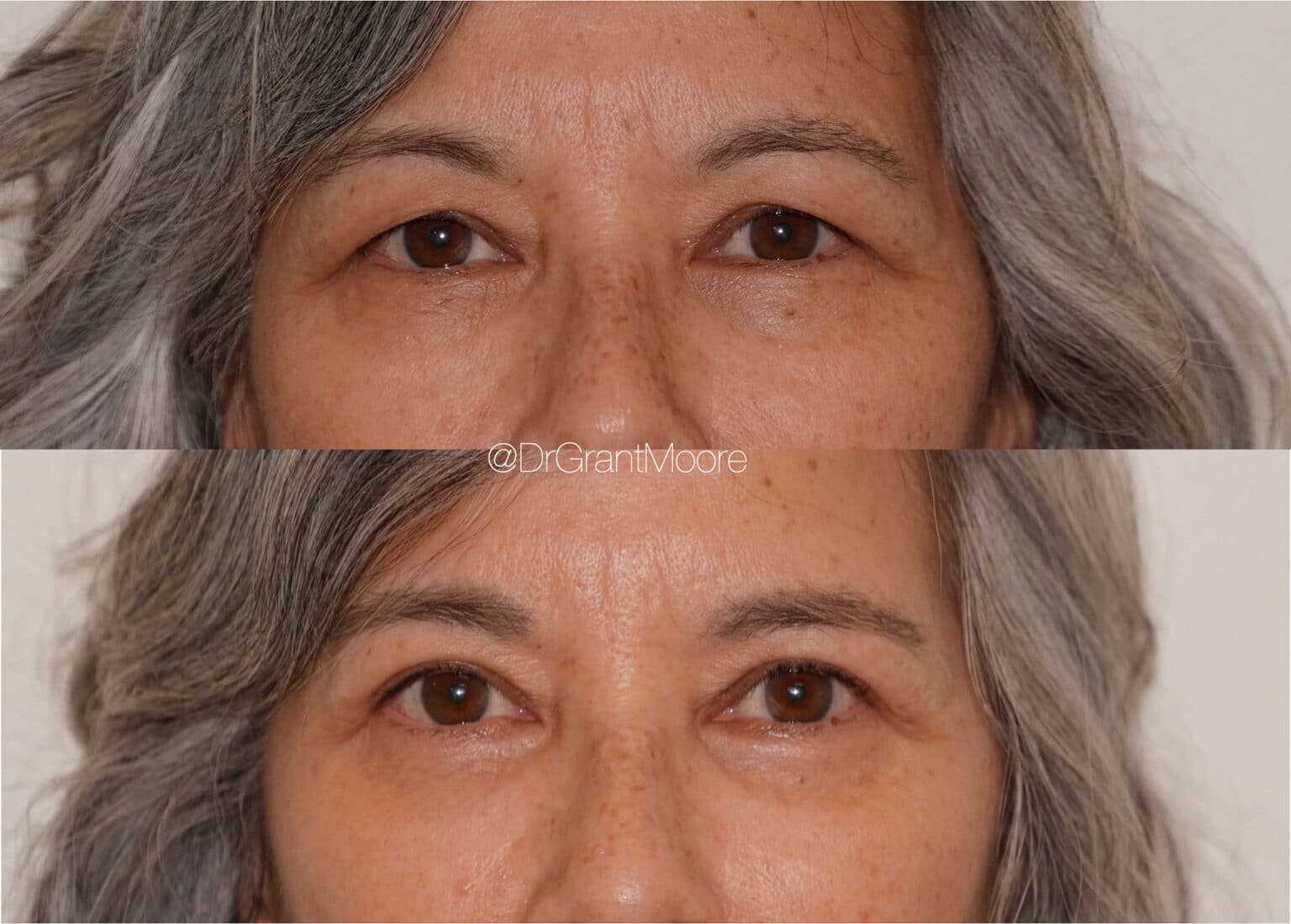 Ophthalmic Plastic Surgery Gallery | Barnet Dulaney Perkins AZ