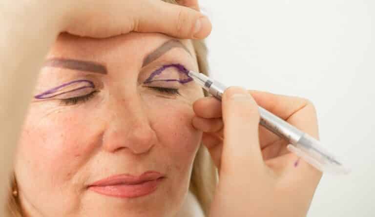 Blepharoplasty FAQ's — Barnet Dulaney Perkins Eye Center