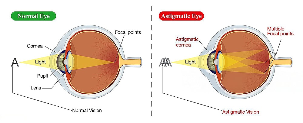Blurry and Hazy Vision Causes and Treatment